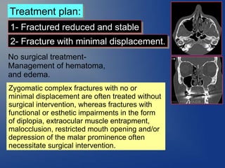 Zygomatic complex fracture | PPT