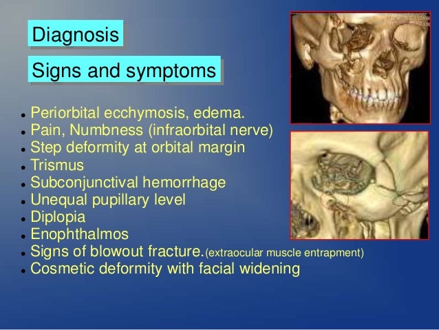 Zygomatic complex fracture