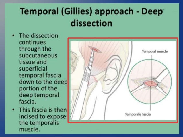 Zygomatic complex fracture