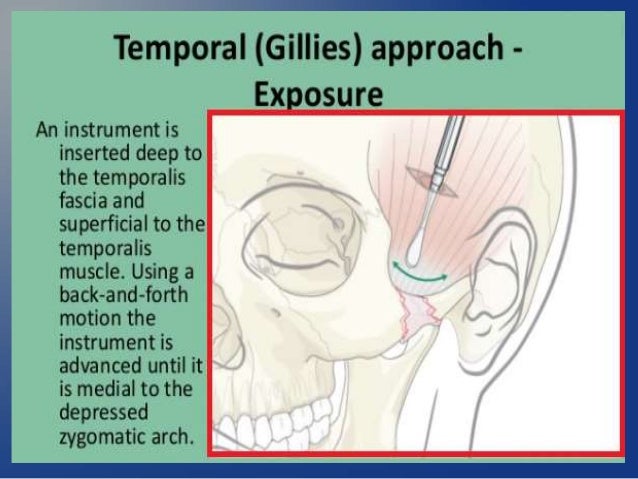 Zygomatic complex fracture