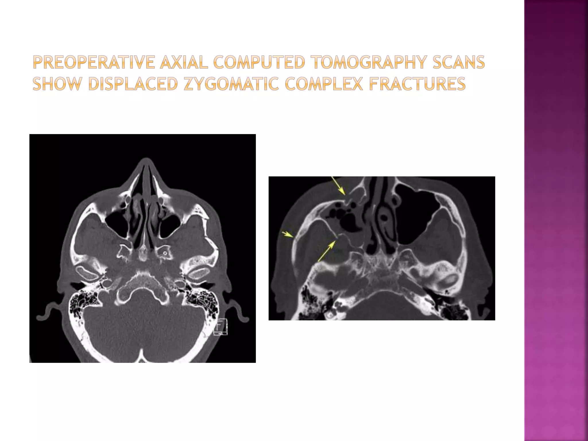 Zygomatic complex fracture | PPTX