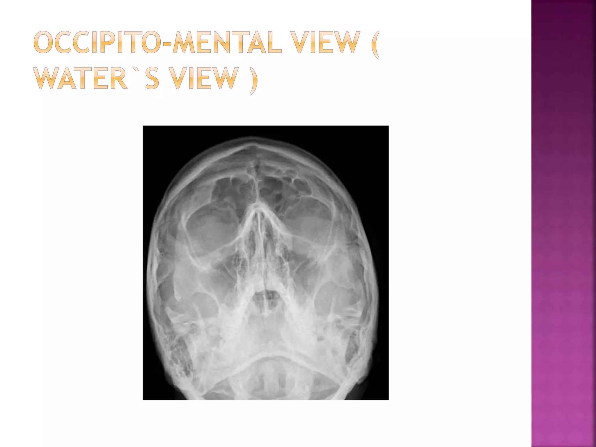 Zygomatic complex fracture | PPTX