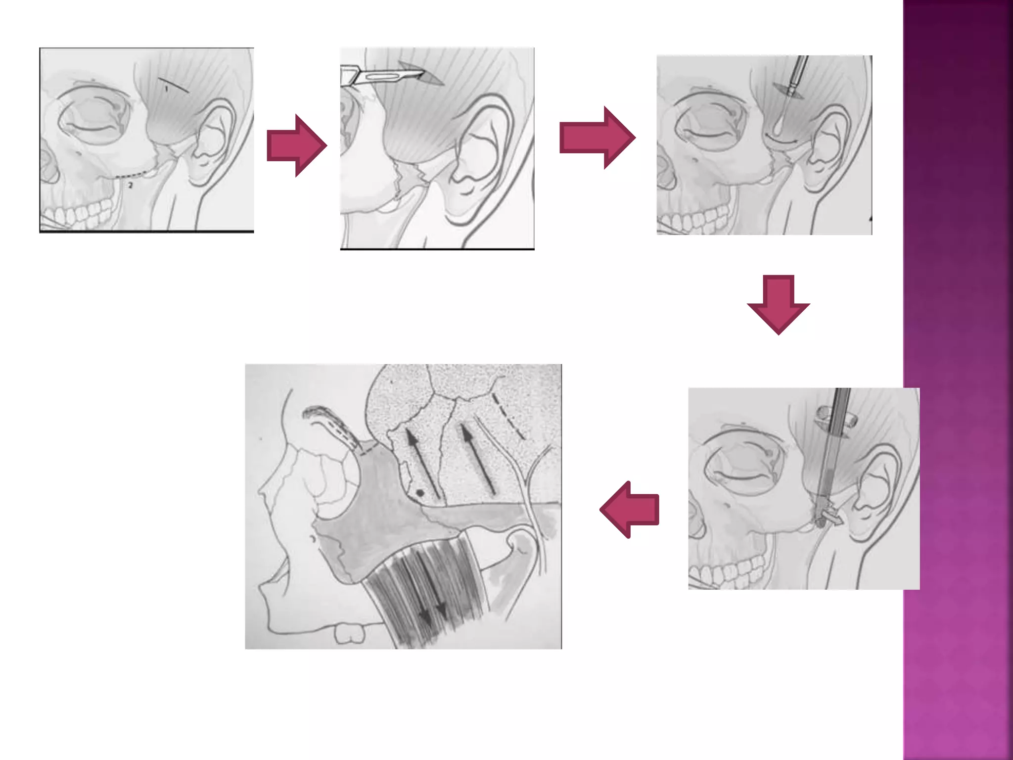 Zygomatic complex fracture | PPTX