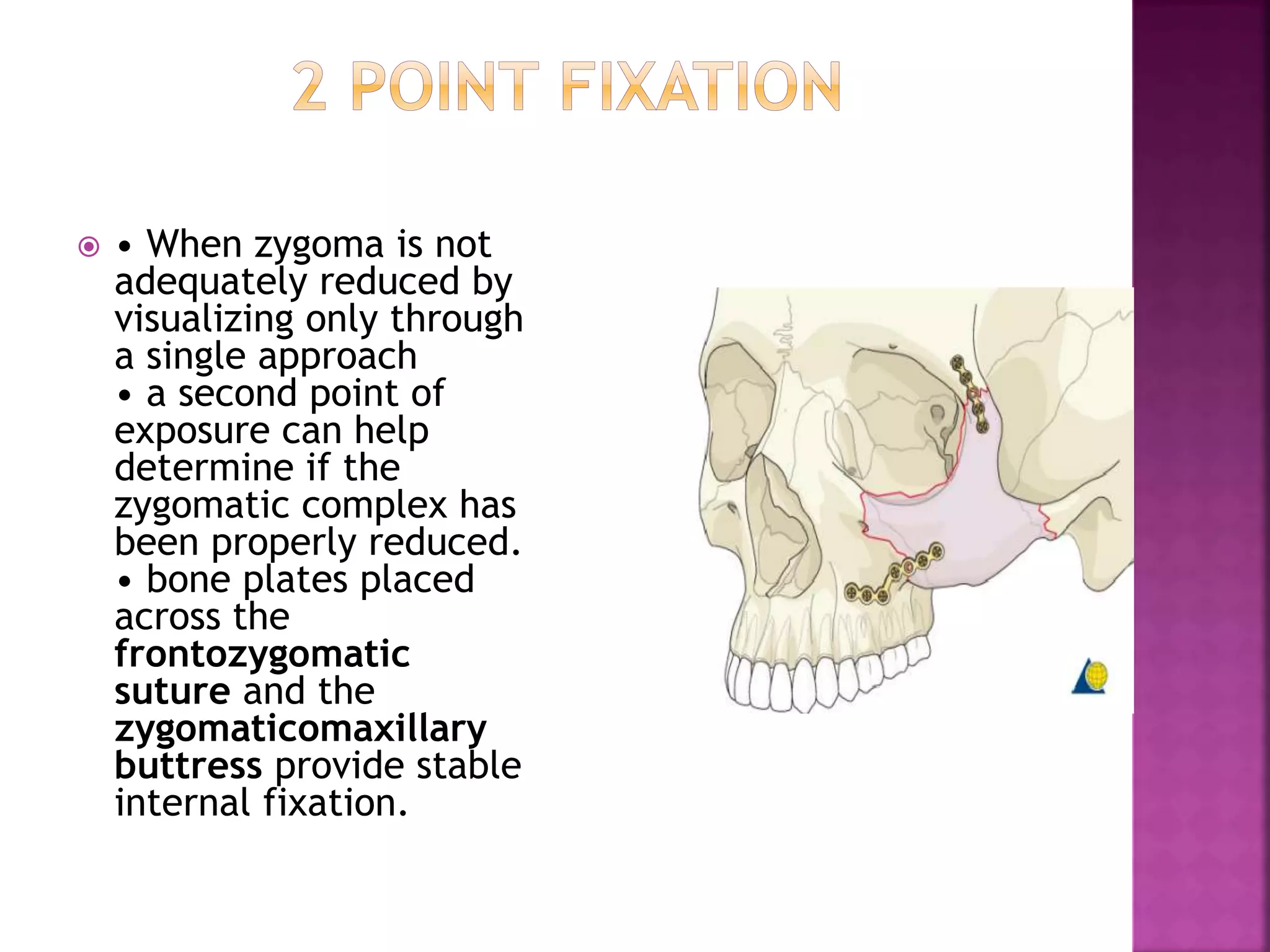 Zygomatic complex fracture | PPTX