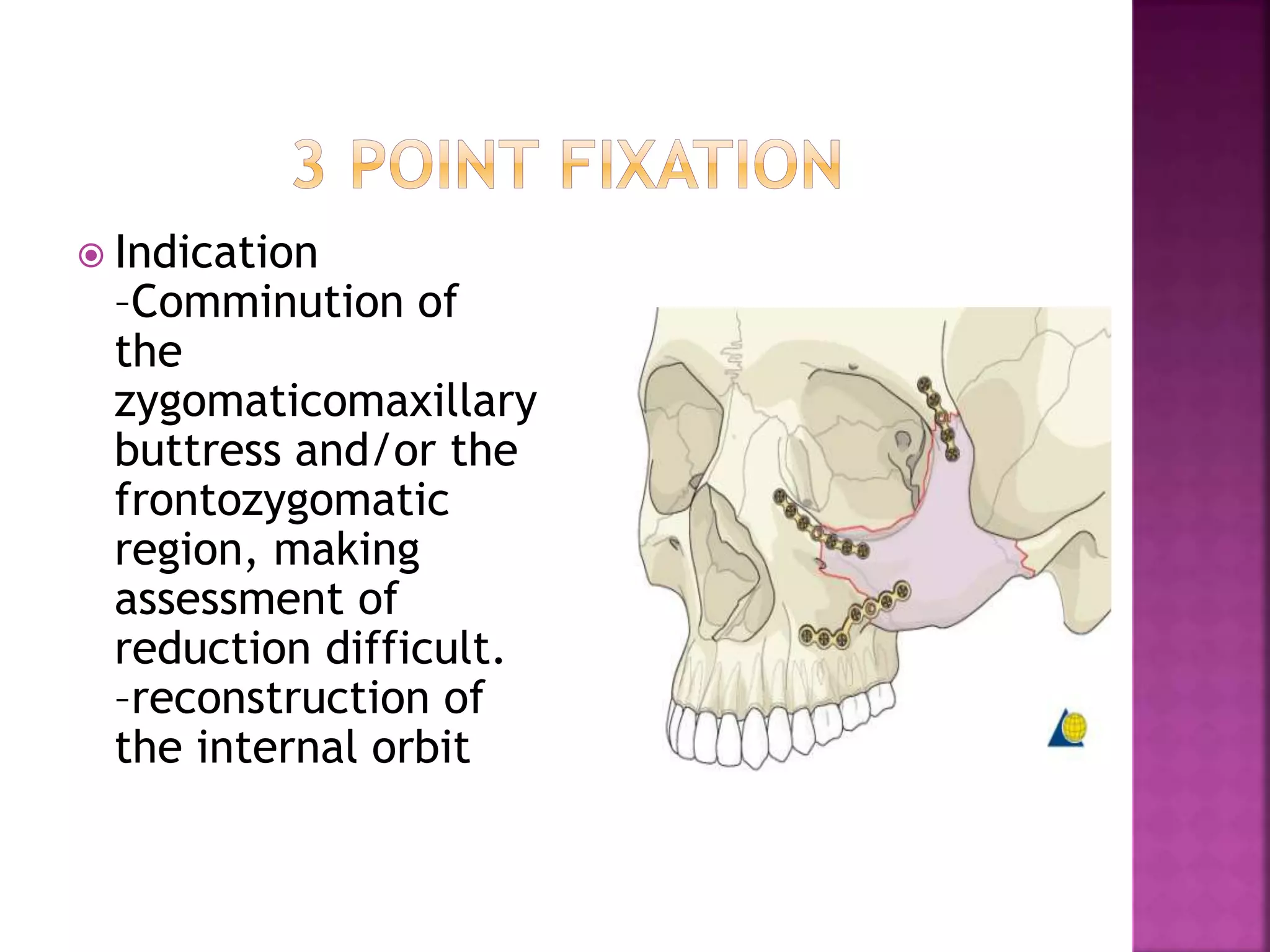 Zygomatic complex fracture | PPTX