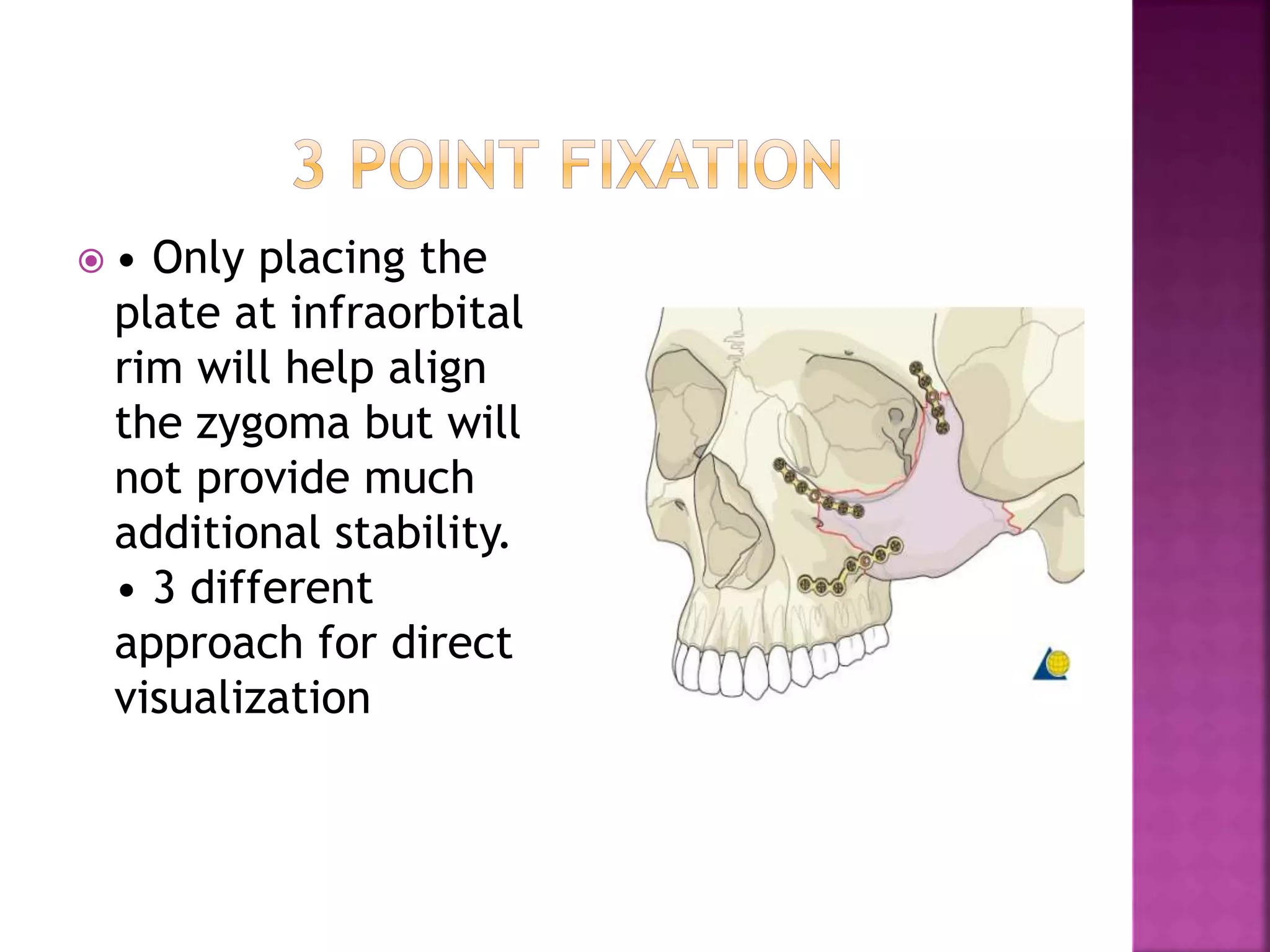 Zygomatic complex fracture | PPTX