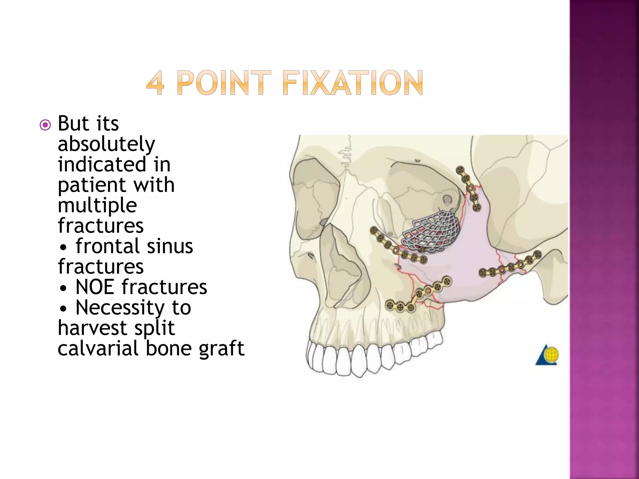 Zygomatic complex fracture | PPTX