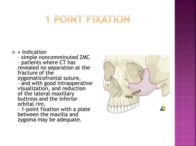 Zygomatic complex fracture | PPTX