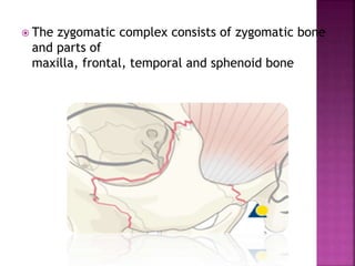 Zygomatic complex fracture | PPTX