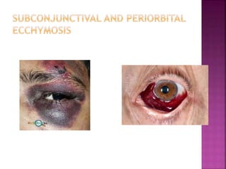 Zygomatic complex fracture | PPTX