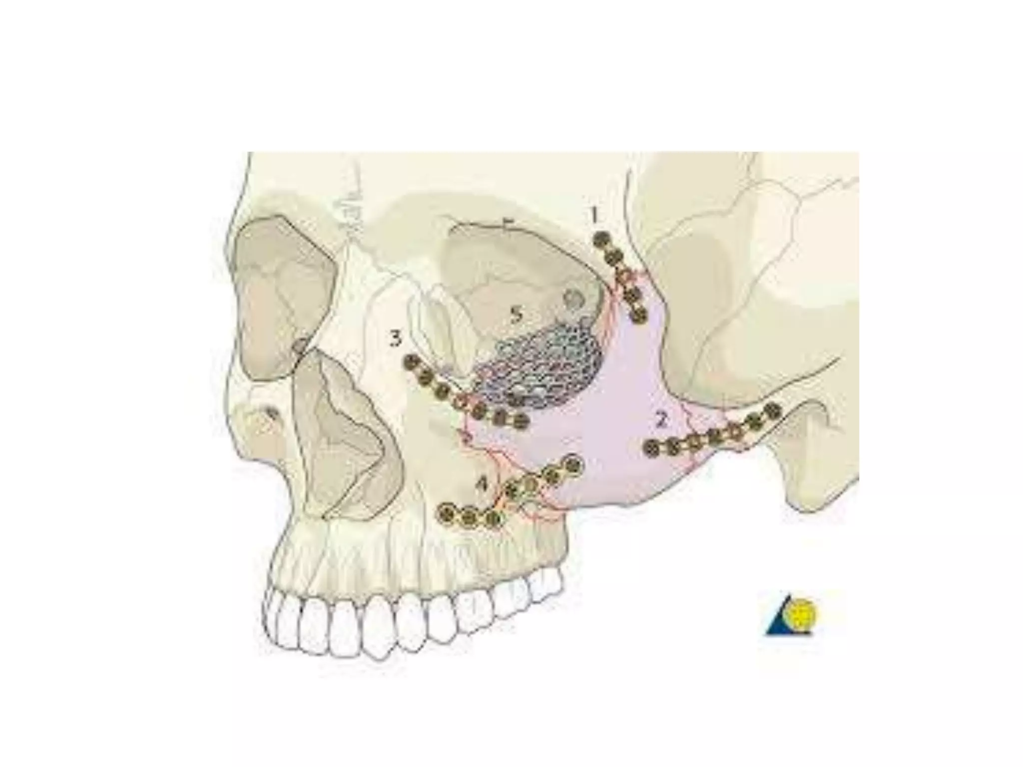 ZYGOMATIC COMPLEX FRACTURE DAVISpptx | PPTX
