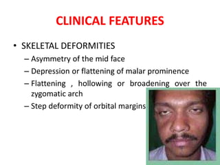 ZYGOMATIC COMPLEX FRACTURE DAVISpptx | PPTX