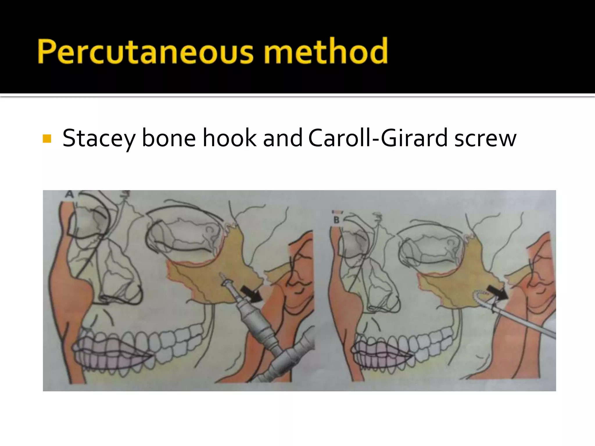 Zygomatic complex fractures | PPTX