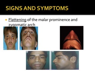 Zygomatic complex fractures | PPTX