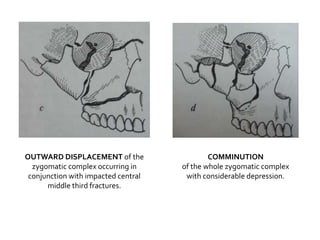 Zygomatic complex fractures | PPTX