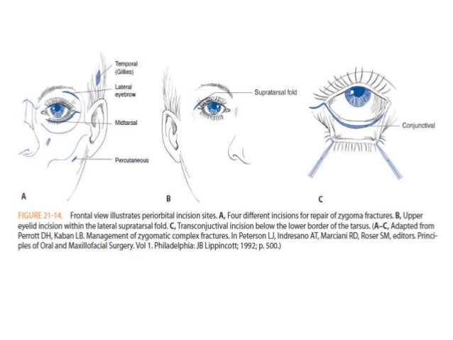 Zygomatic complex fractures