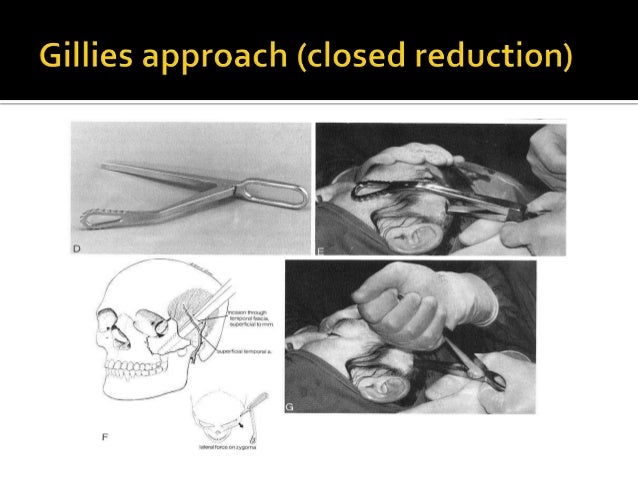 Zygomatic complex fractures