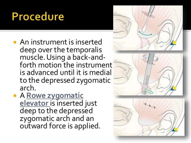 Zygomatic complex fractures