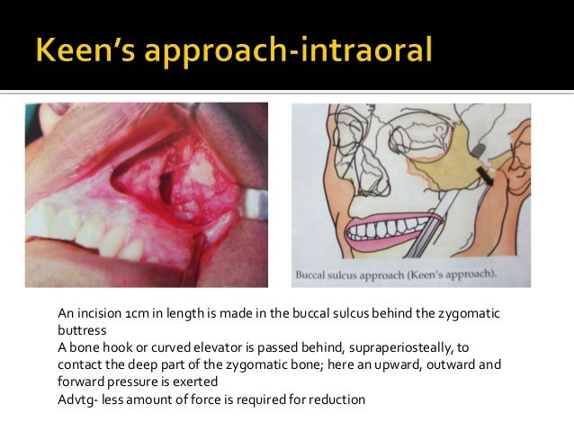 Zygomatic complex fractures