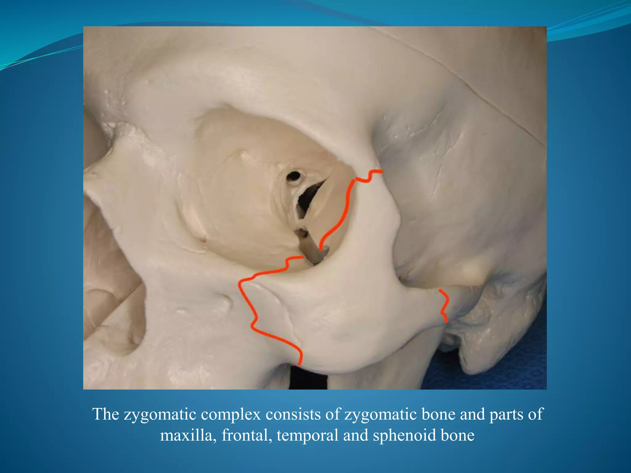Zygomatic complex fractures | PPTX