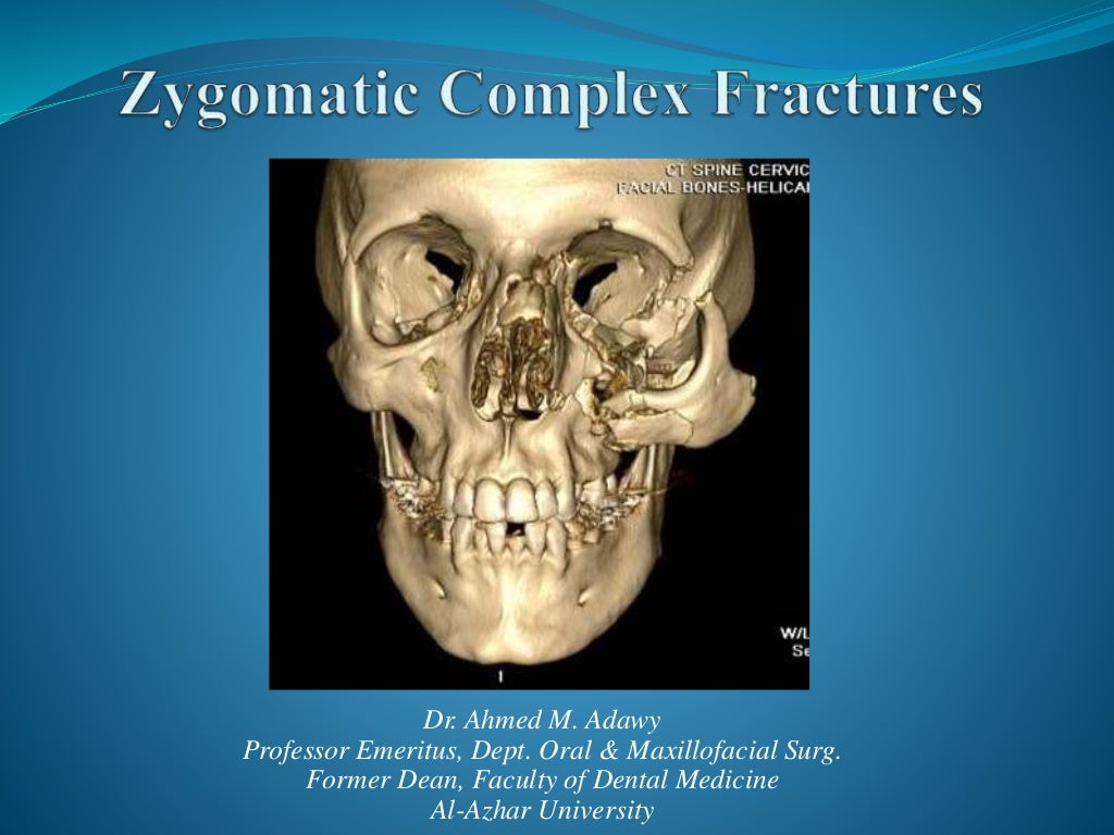 Zygomatic complex fractures