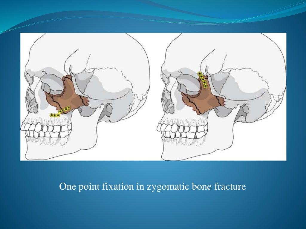 Zygomatic complex fractures