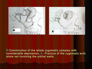 Zygomatic complex fractures ih | PPT