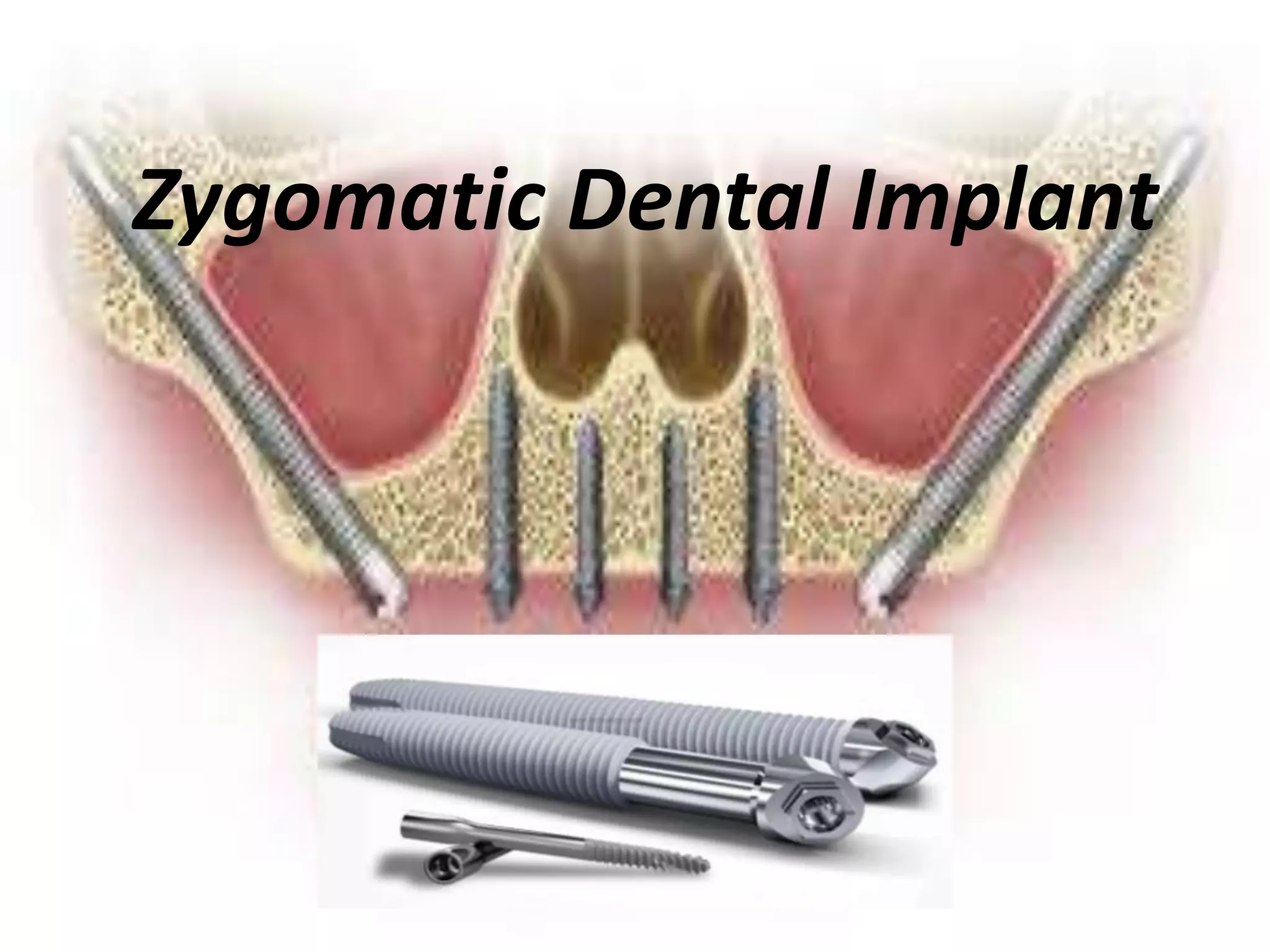 Zygomatic dental implant | PPTX