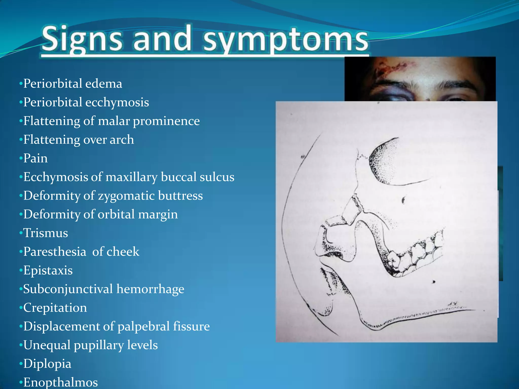 Zygomatic fractures | PPTX