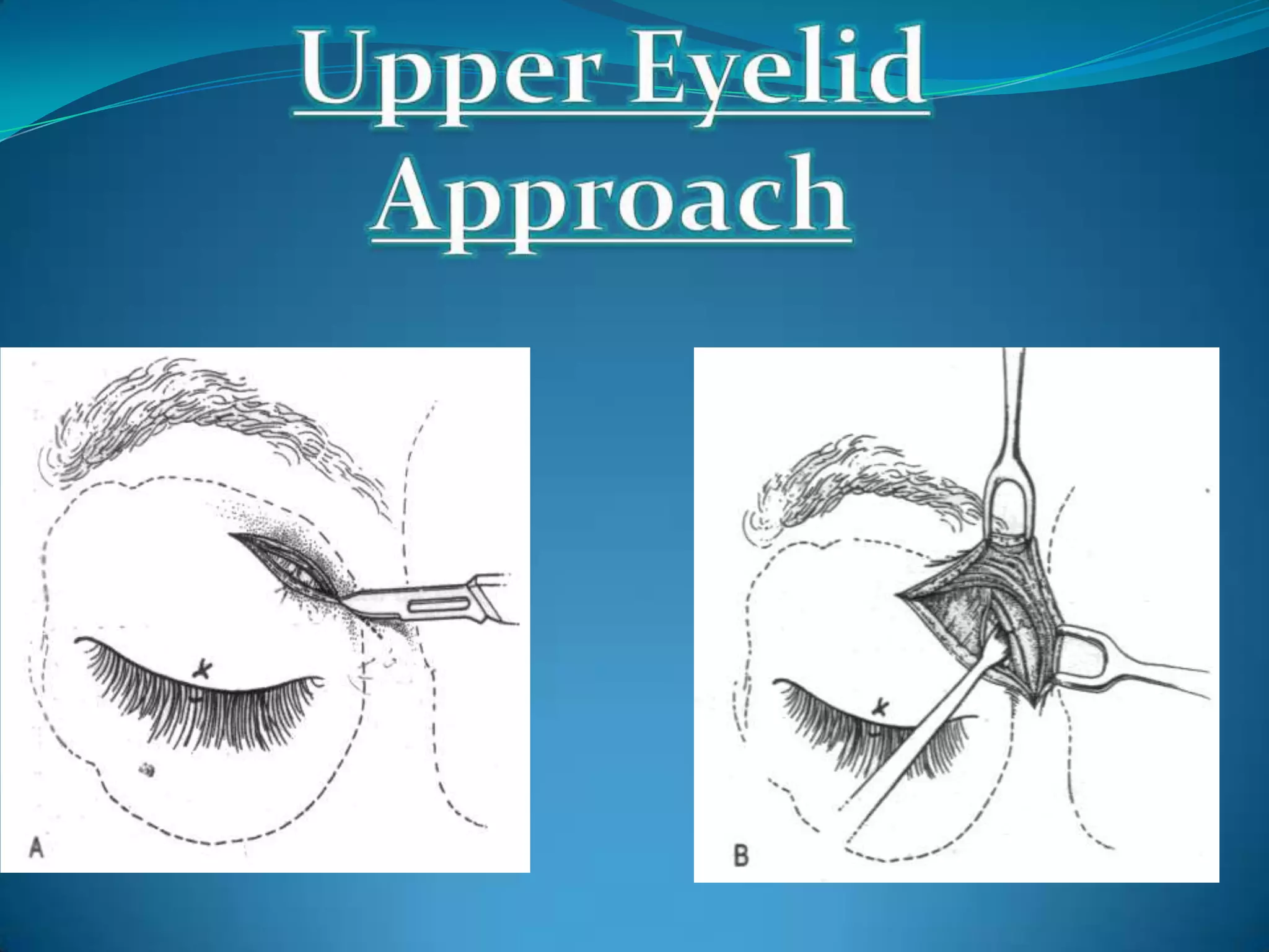Zygomatic fractures | PPTX
