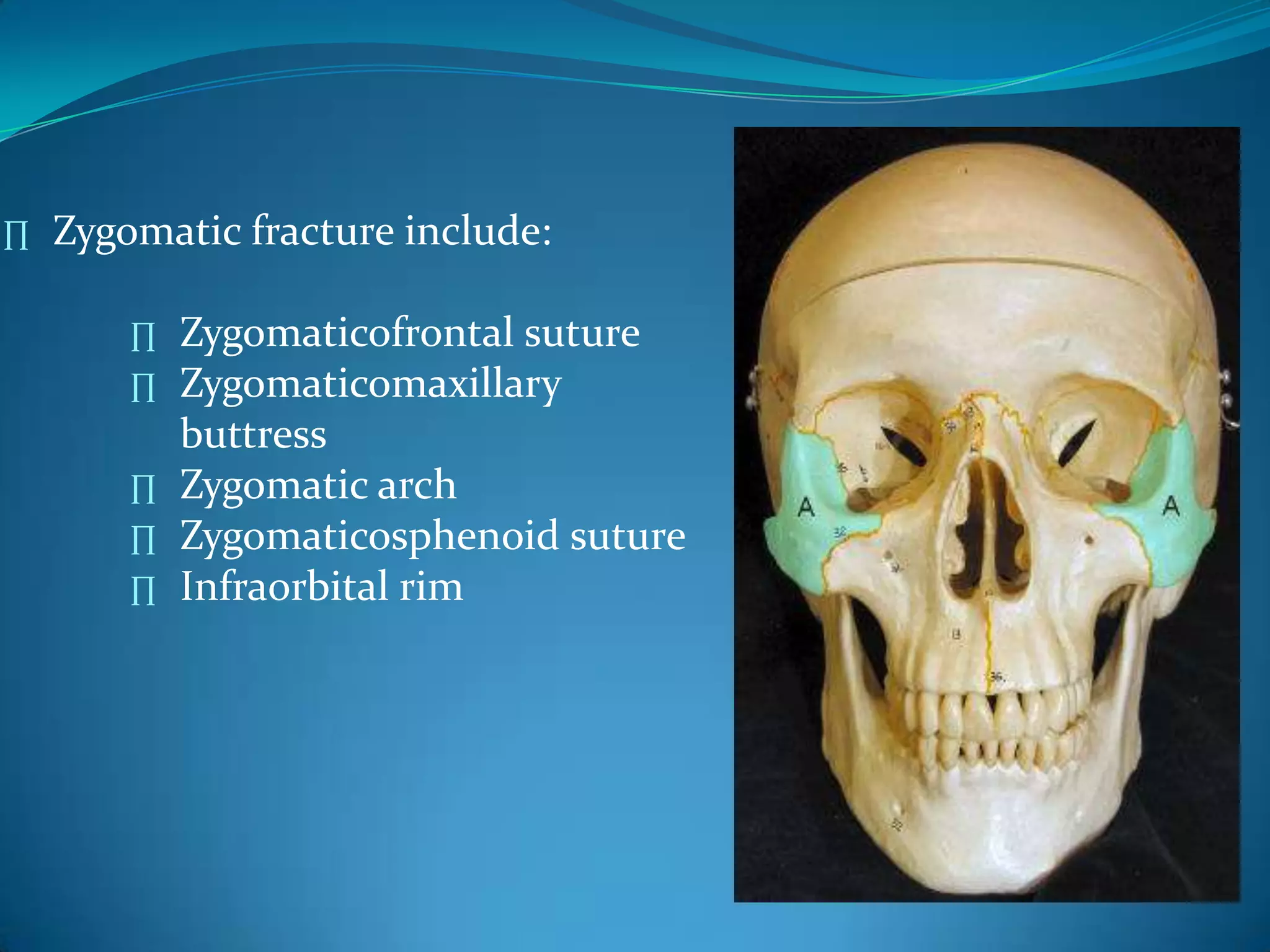 Zygomatic fractures | PPTX
