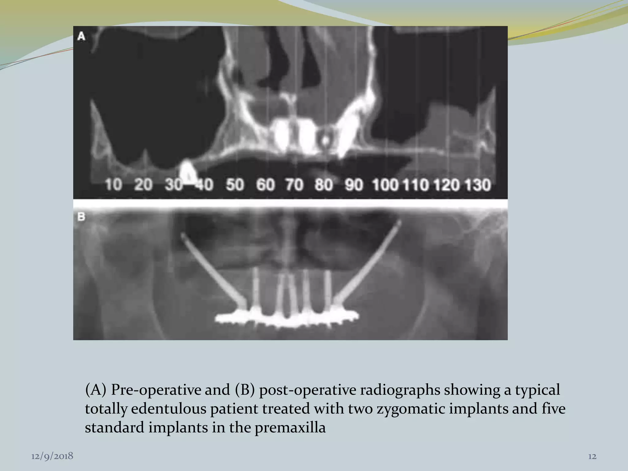 Zygomatic implants | PPTX