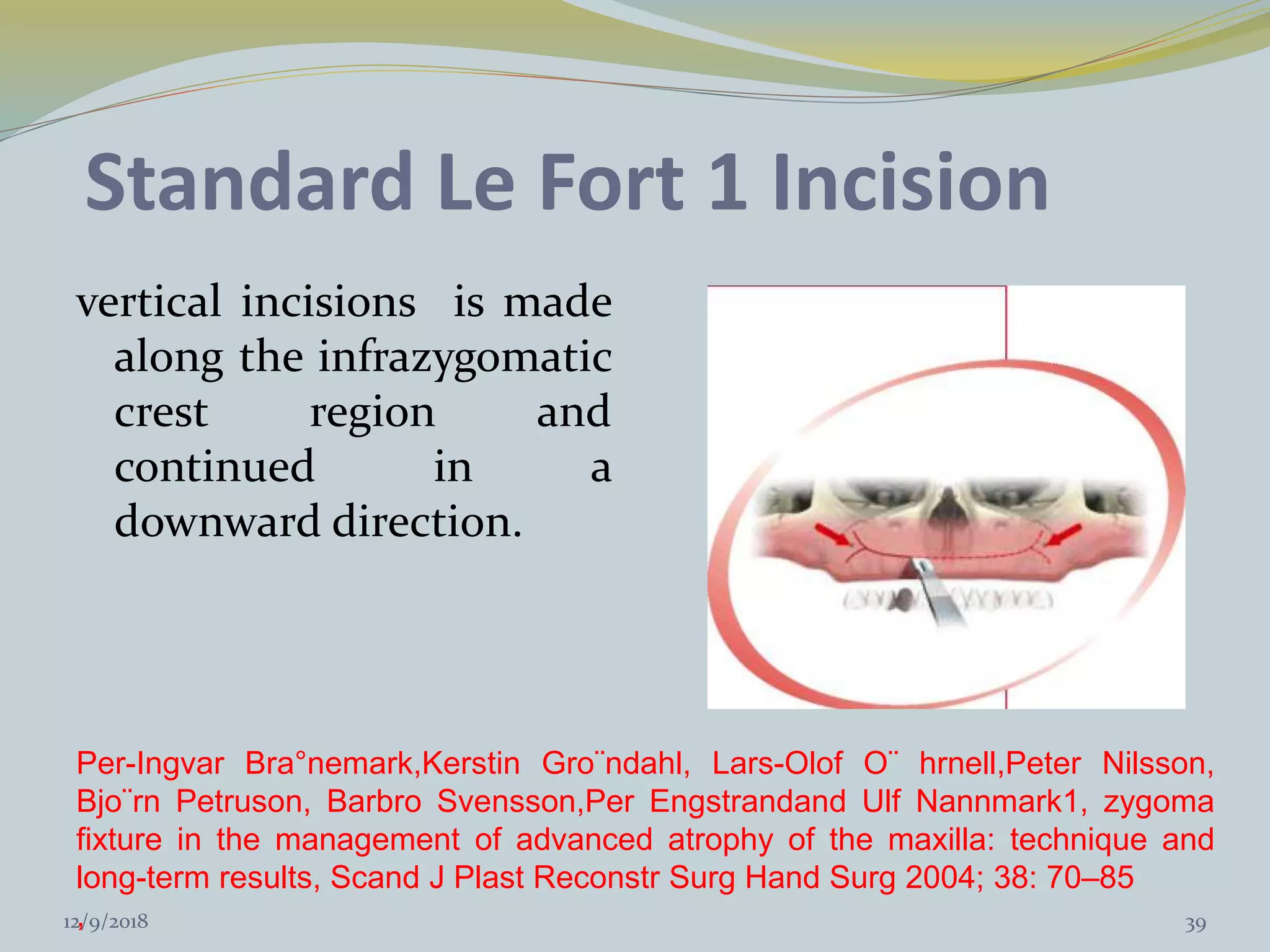Zygomatic implants | PPTX