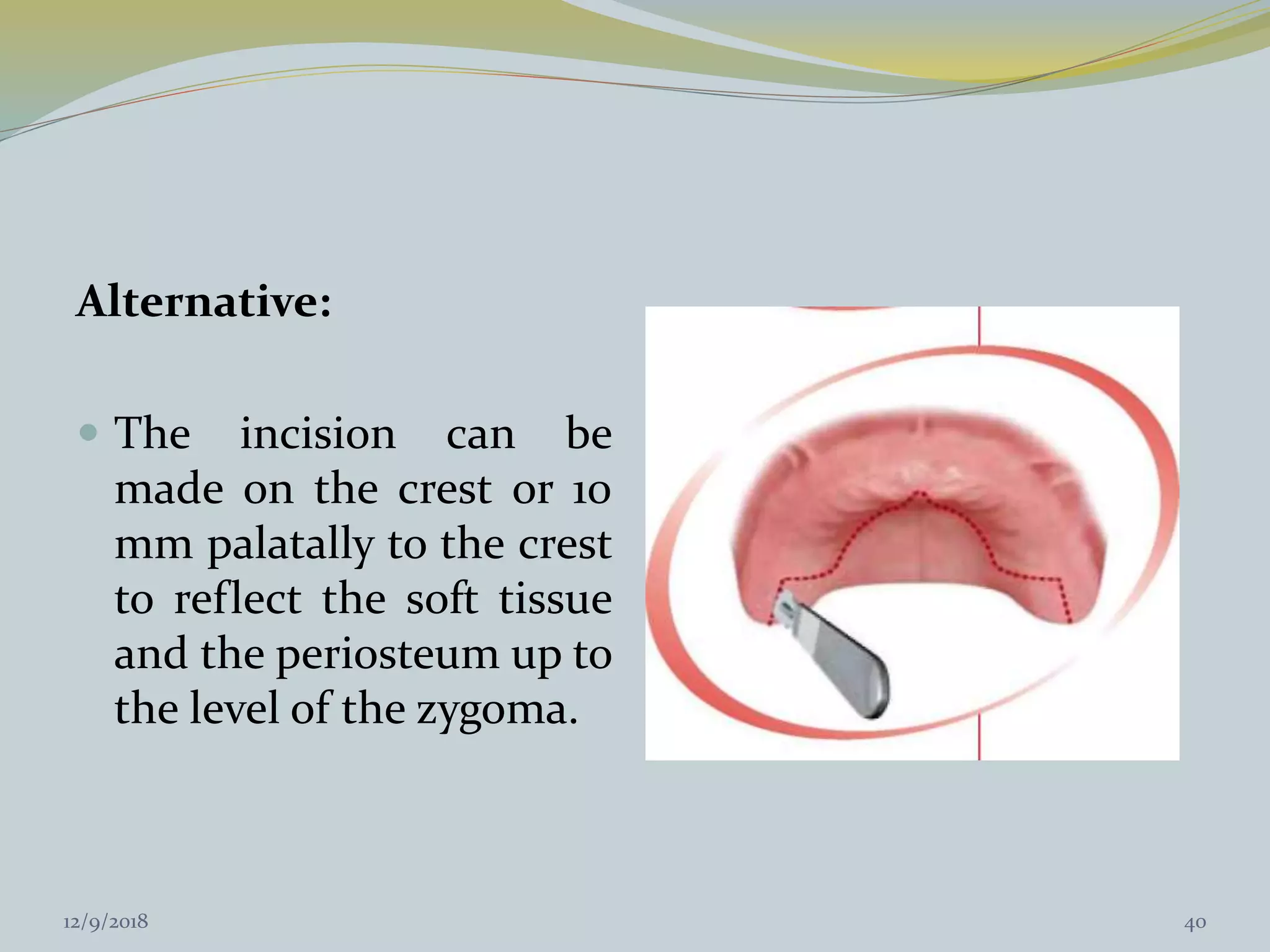 Zygomatic implants | PPTX