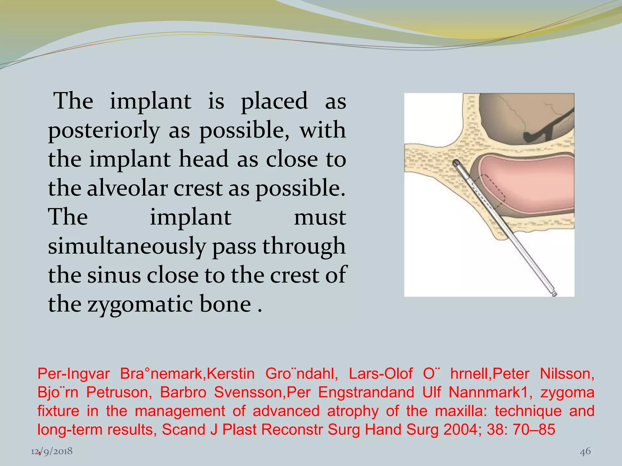 Zygomatic implants | PPTX