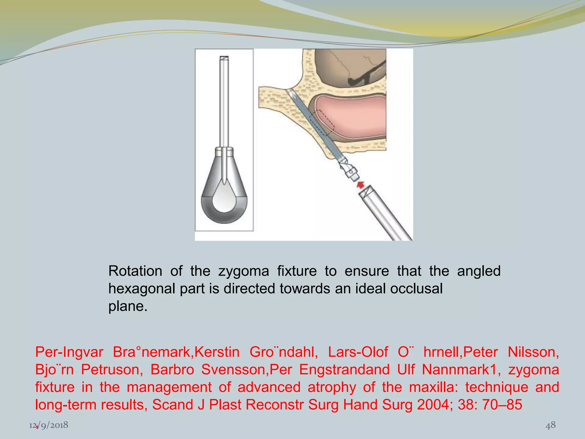 Zygomatic implants | PPTX