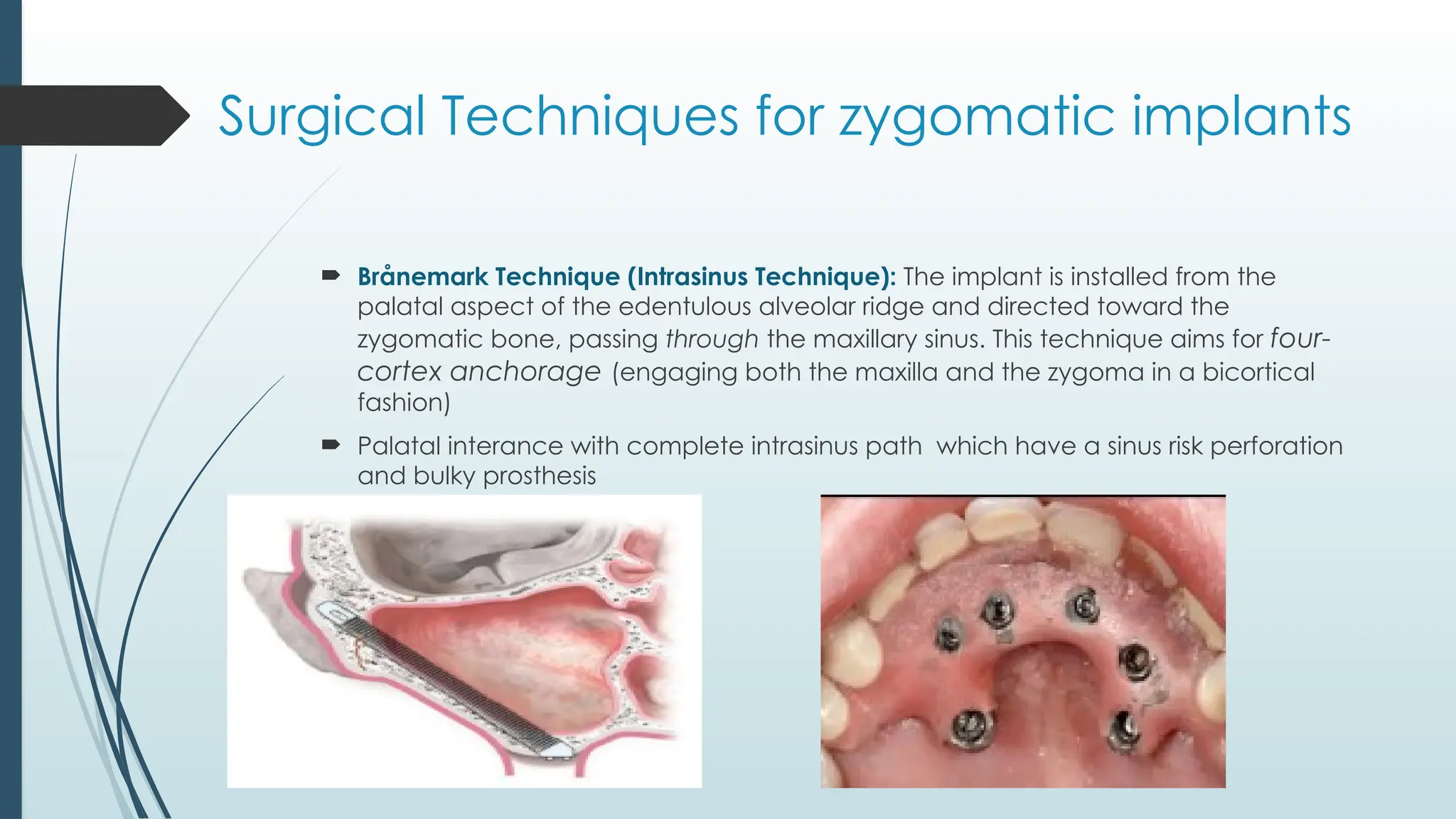 zygomatic implants and ptrygoid implants.pptx