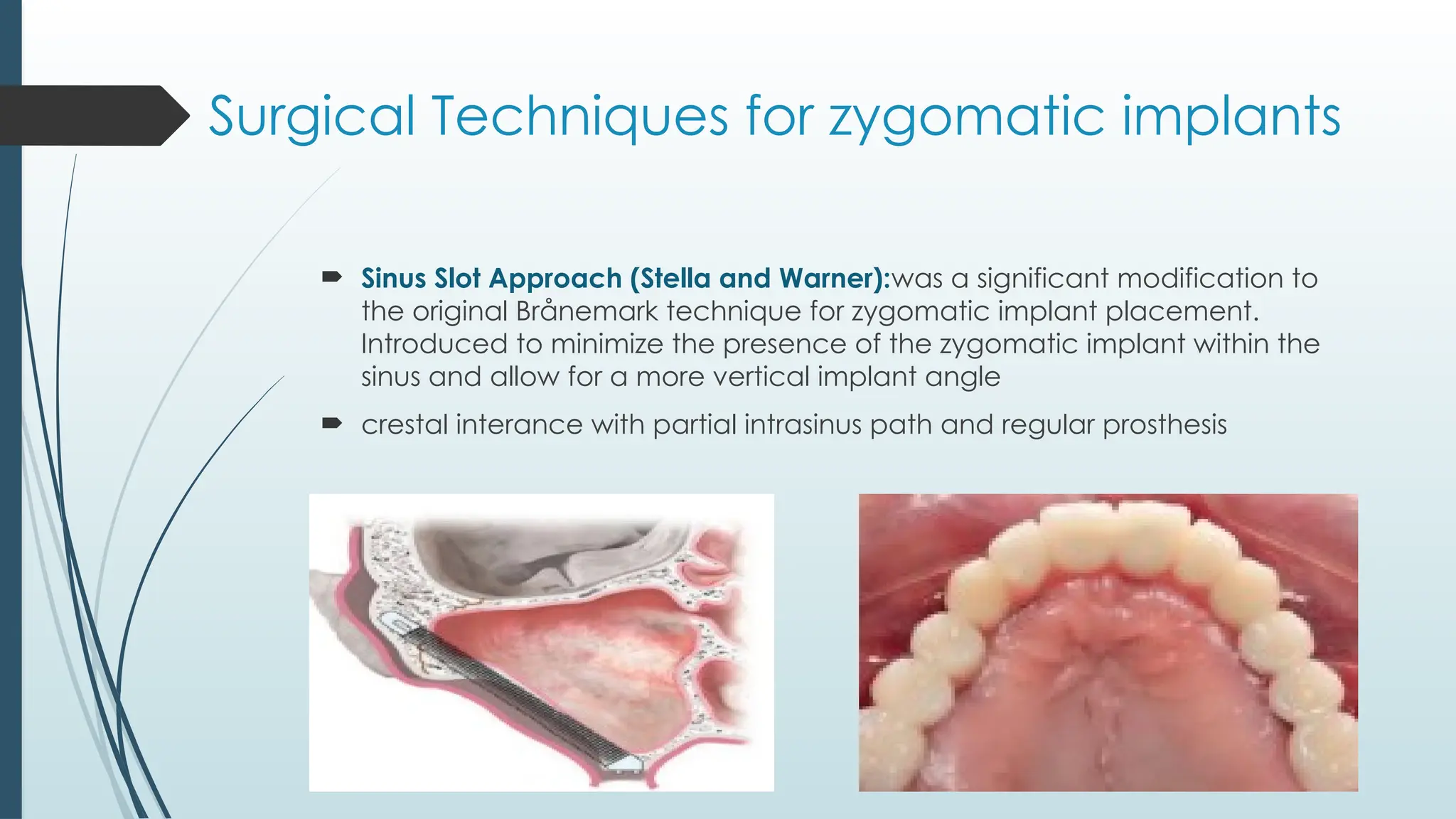 zygomatic implants and ptrygoid implants.pptx