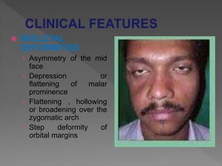 ZYGOMATICO MAXILLARY COMPLEX FRACTURE | PPTX