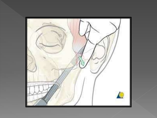 ZYGOMATICO MAXILLARY COMPLEX FRACTURE | PPTX | Death, Injury, or ...