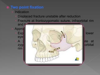 ZYGOMATICO MAXILLARY COMPLEX FRACTURE | PPT