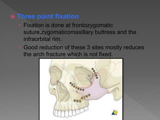 Frontozygomatic Suture