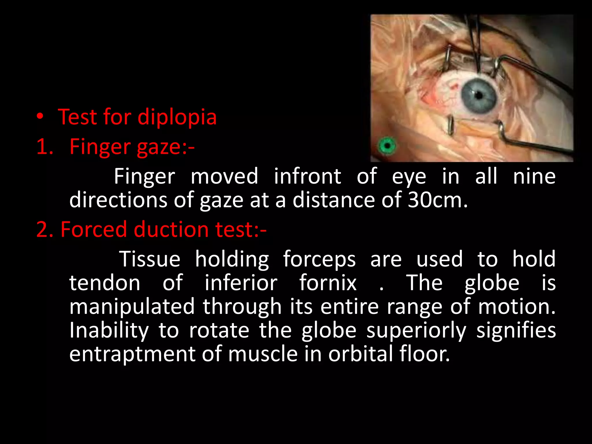 Zygomatic maxillary complex fracture | PPTX