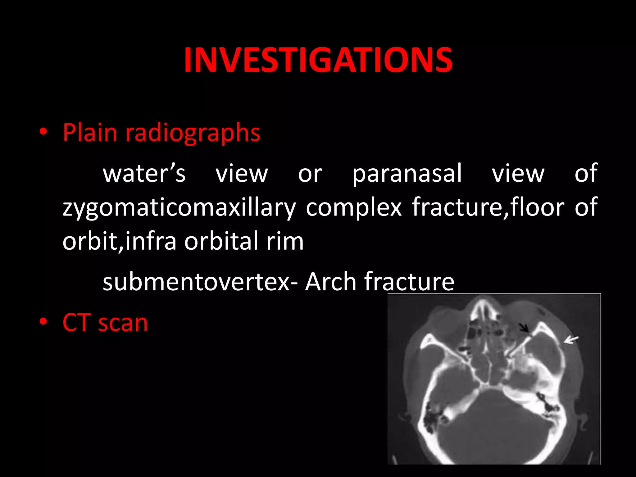Zygomatic maxillary complex fracture | PPTX