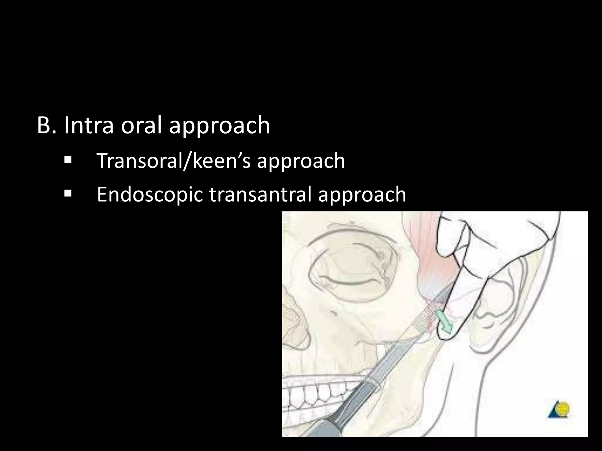 Zygomatic maxillary complex fracture | PPTX