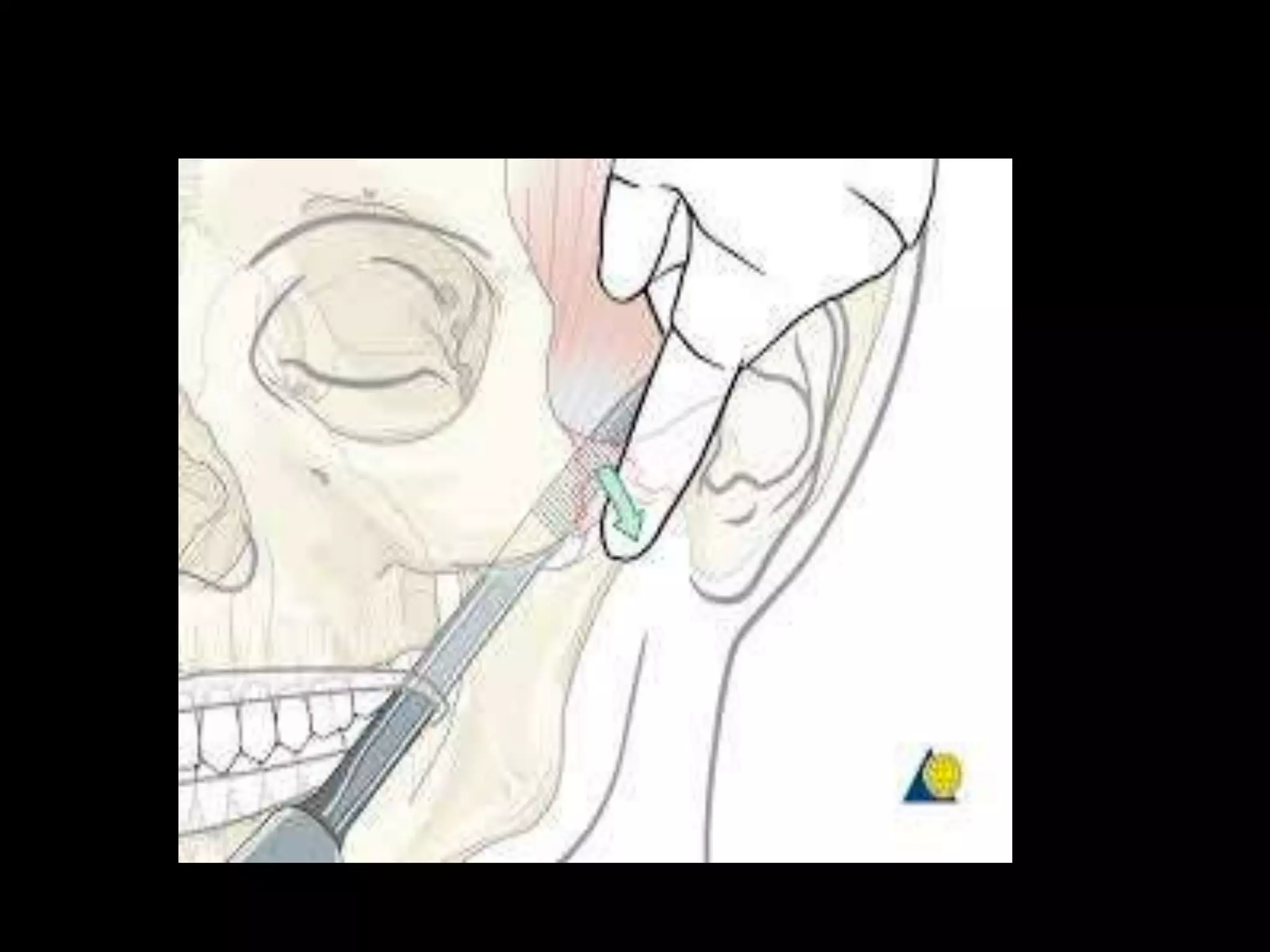 Zygomatic maxillary complex fracture | PPTX