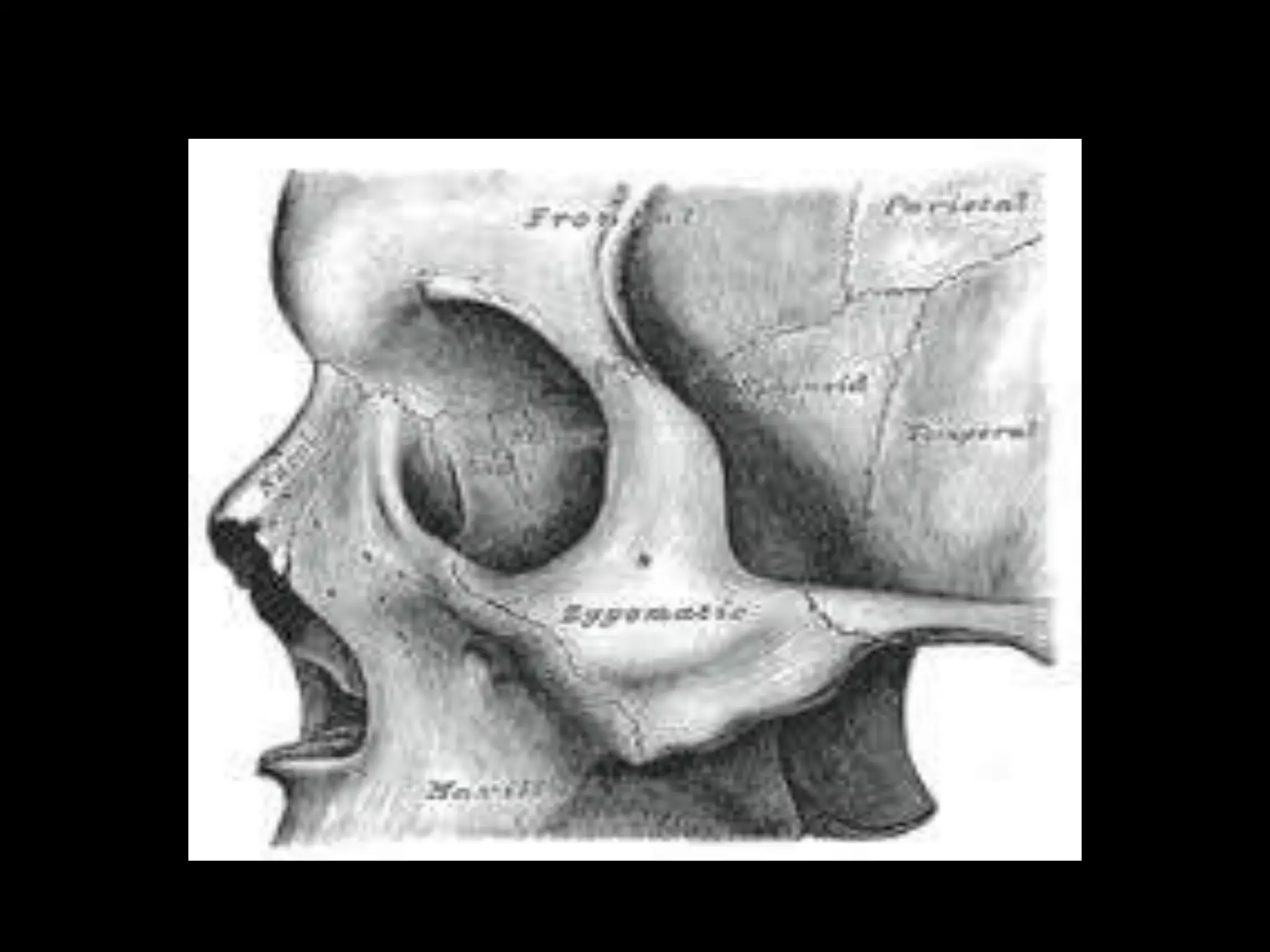 Cpt Orif Zygomatic Maxillary Fracture – QLLGGY