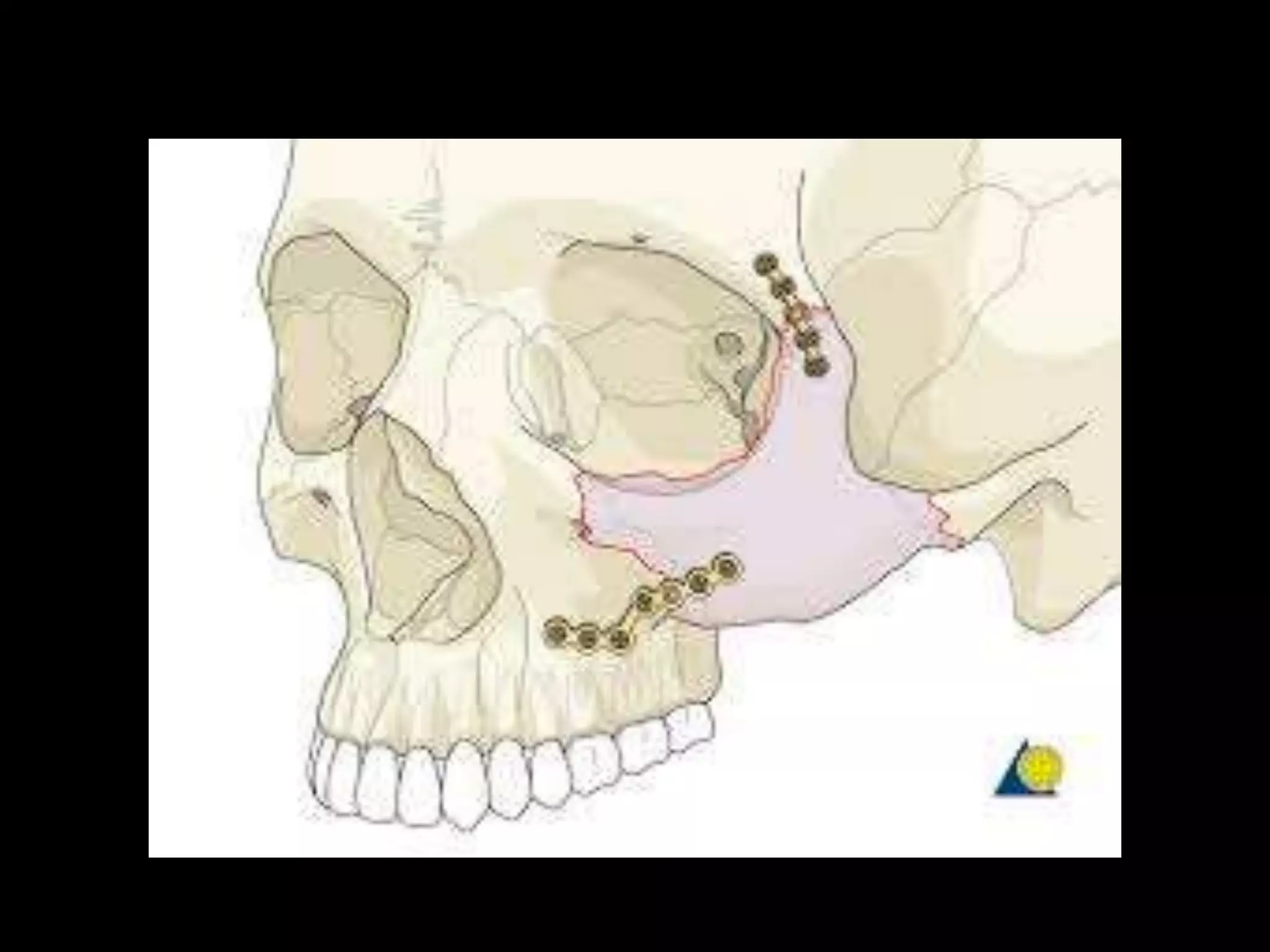 Zygomatic maxillary complex fracture | PPTX