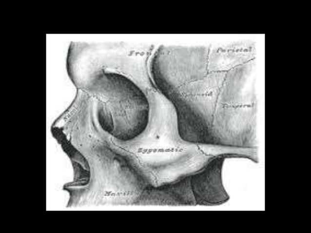 Zygomatic maxillary complex fracture | PPTX