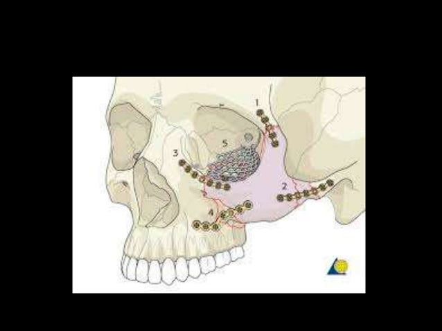 Zygomatic maxillary complex fracture | PPTX